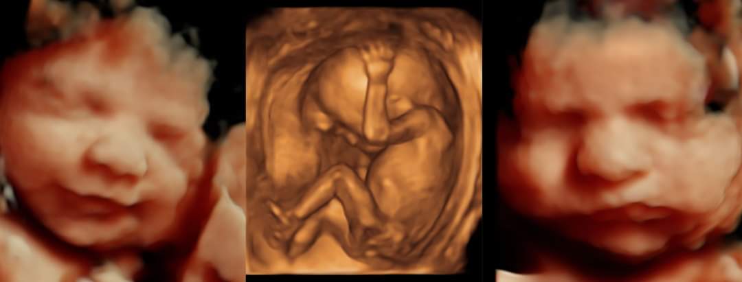 Elective 3D/4D & HD Ultrasounds | Sneak Peek 3D